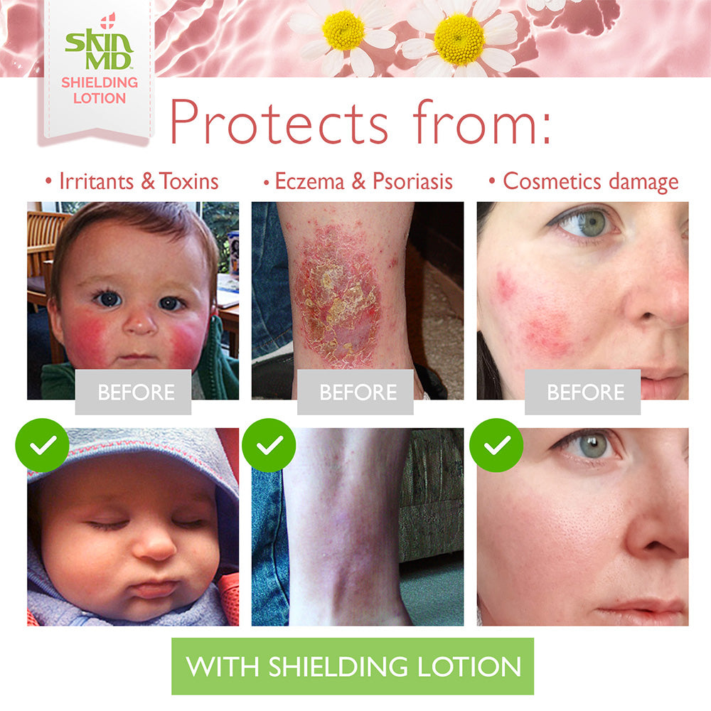 Skin MD Shielding Lotion 8oz (2 Pack) with 2 Pumps – SkinMD Online Store